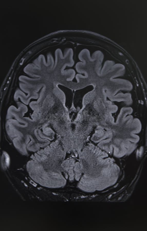 Mri Brain Normal