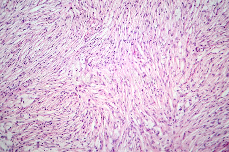 Photomicrograph of a Giant Cell Tumor of Bone, Revealing Its Cellular ...