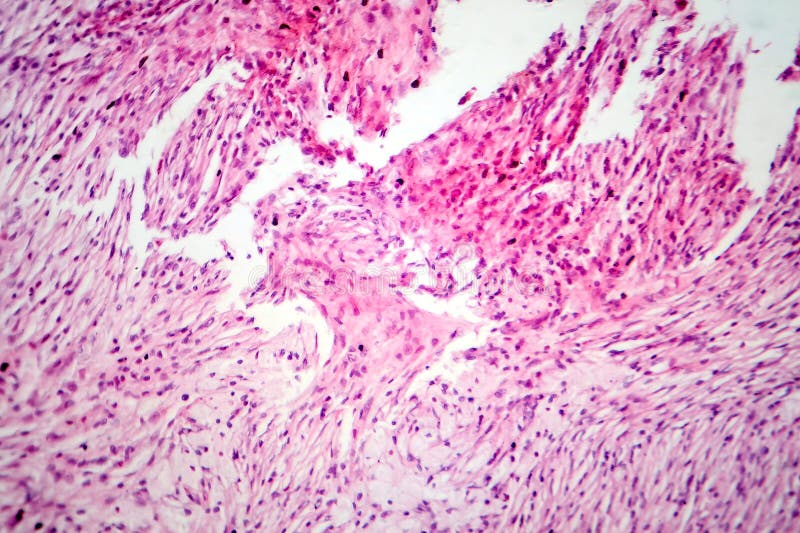 Photomicrograph of a Giant Cell Tumor of Bone, Revealing Its Cellular ...