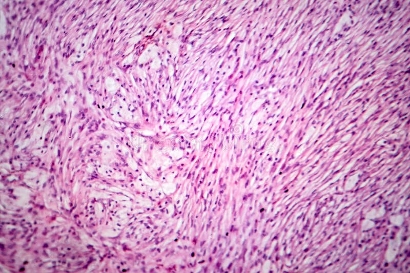 Photomicrograph of a Giant Cell Tumor of Bone, Revealing Its Cellular ...