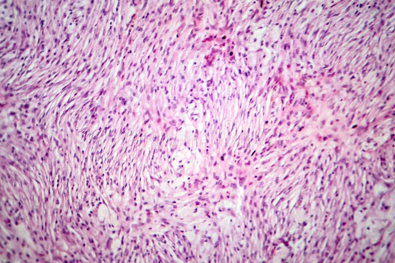 Photomicrograph of a Giant Cell Tumor of Bone, Revealing Its Cellular ...