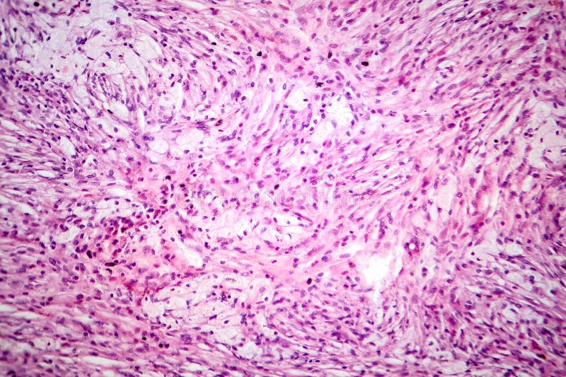Photomicrograph of a Giant Cell Tumor of Bone, Revealing Its Cellular ...