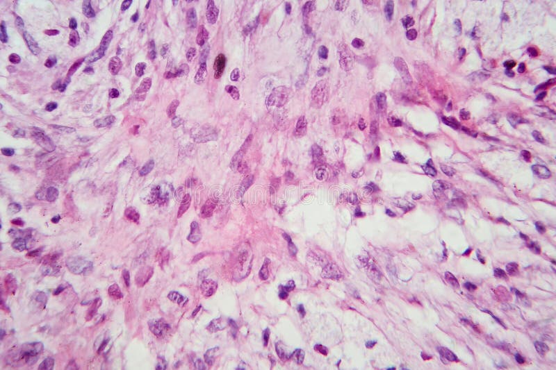 Photomicrograph of a Giant Cell Tumor of Bone, Revealing Its Cellular ...