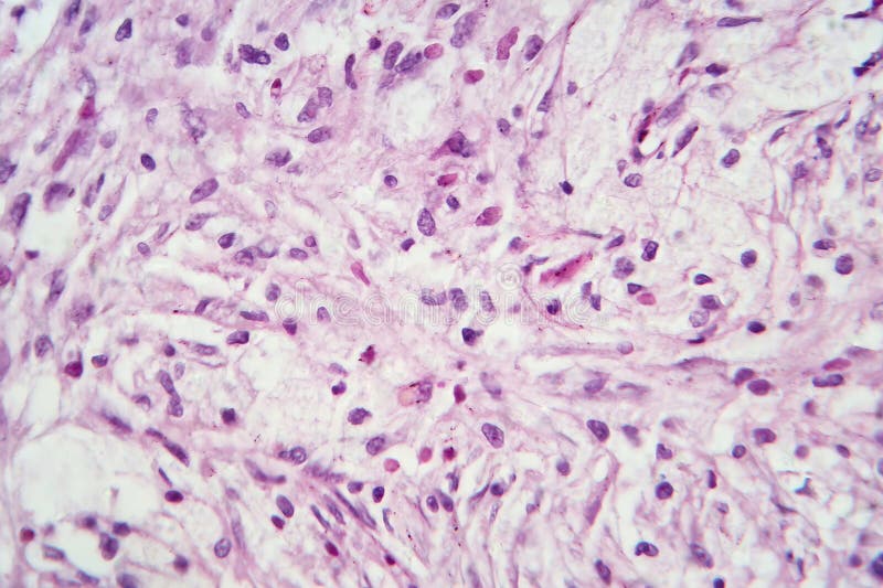 Photomicrograph of a Giant Cell Tumor of Bone, Revealing Its Cellular ...
