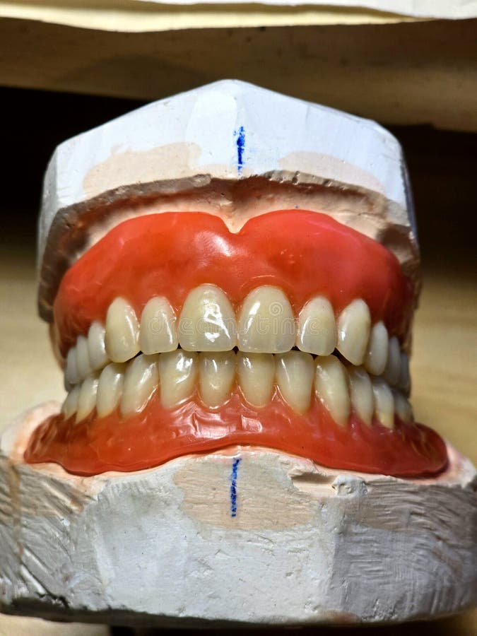 Photos of dentures in wax. stock image. Image of cheek - 357748103