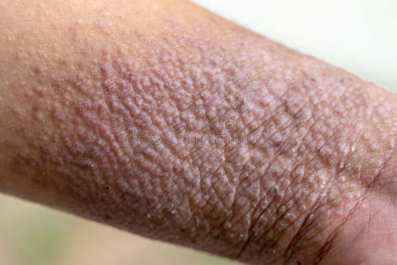 A Physical of Atopic Dermatitis AD, Also Known As Atopic Eczema Stock ...