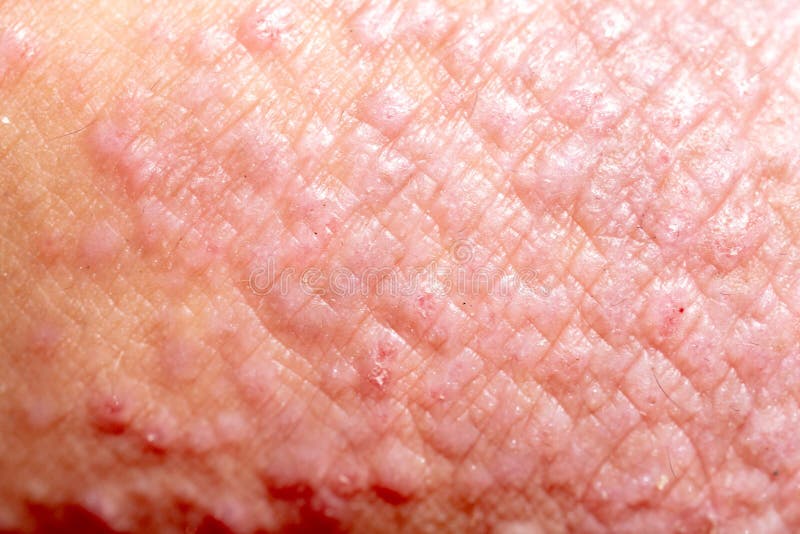 Atopic Dermatitis Ad Also Known As Atopic Eczema Is A Type Of