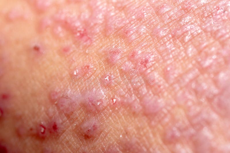 Atopic Dermatitis AD, Also Known As Atopic Eczema, is a Type of ...