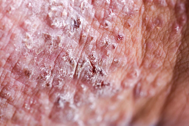 Atopic Dermatitis AD, Also Known As Atopic Eczema, is a Type of ...