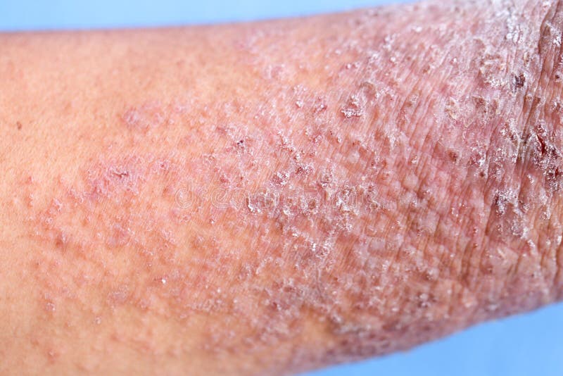 Atopic Dermatitis Ad Also Known As Atopic Eczema Is A Type Of