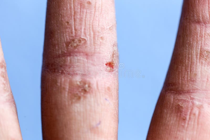 Atopic Dermatitis AD, Also Known As Atopic Eczema, is a Type of ...