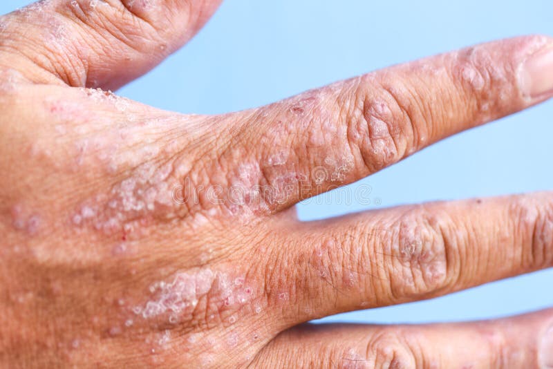 Atopic Dermatitis AD, Also Known As Atopic Eczema, is a Type of ...