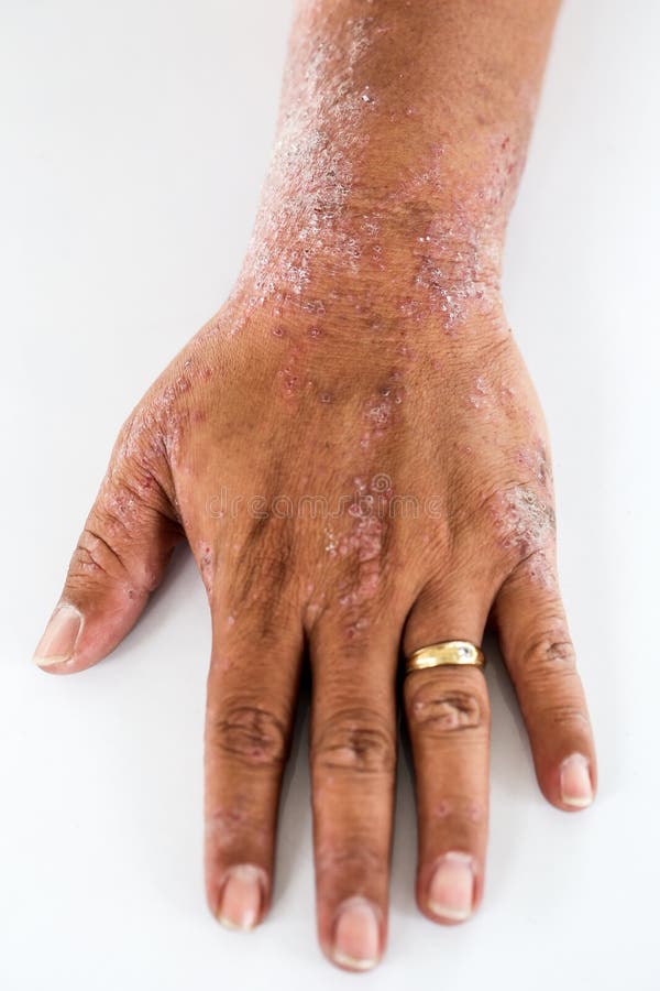 Atopic Dermatitis AD, Also Known As Atopic Eczema, is a Type of ...