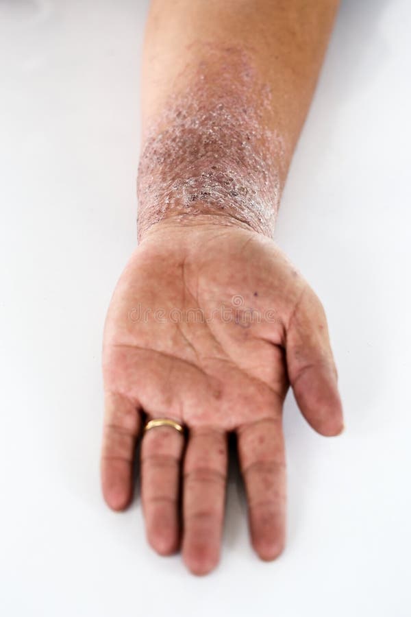 Atopic Dermatitis AD, Also Known As Atopic Eczema, is a Type of ...