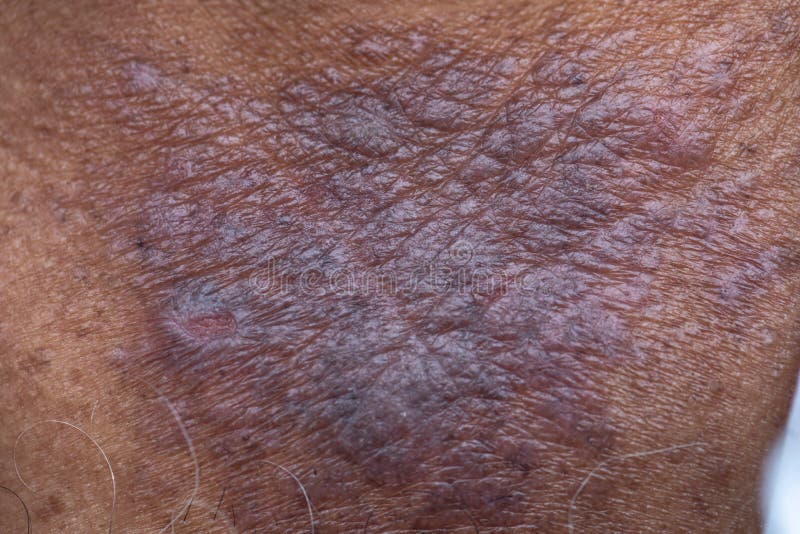 A Physical of Atopic Dermatitis AD, Also Known As Atopic Eczema Stock ...