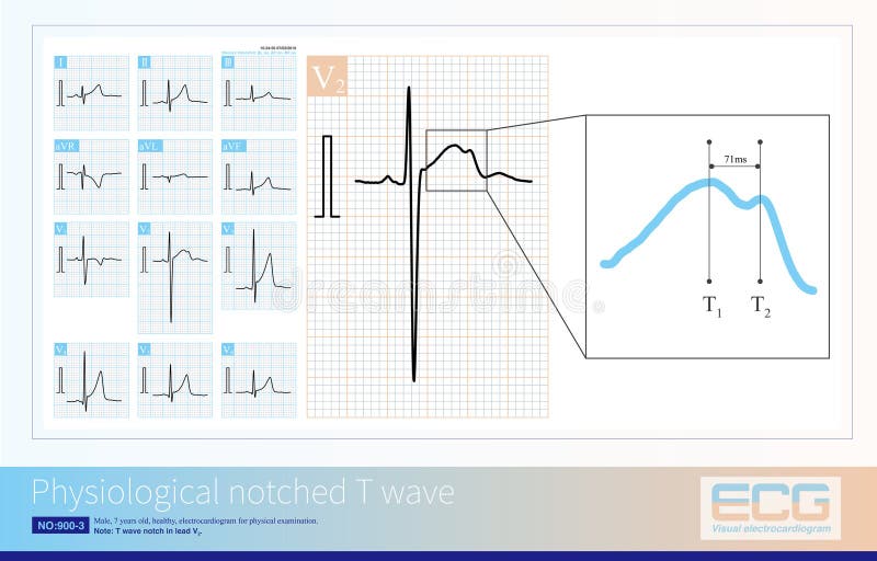 Physiological Notched T Wave Stock Photo - Image of cardiology, anatomy ...