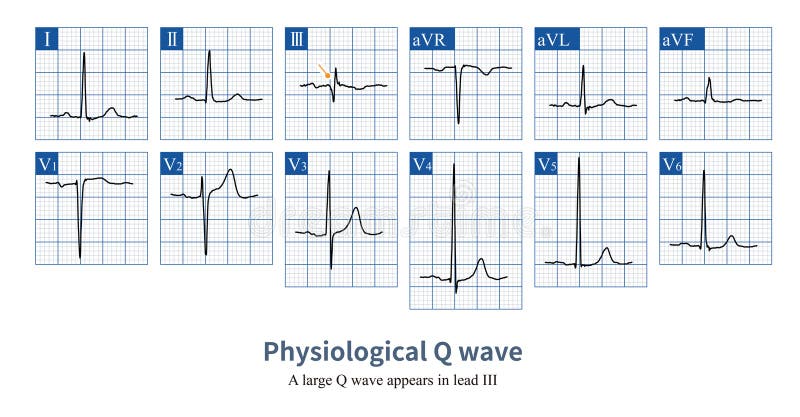 Physiological Q Wave Stock Illustrations – 2 Physiological Q Wave Stock ...