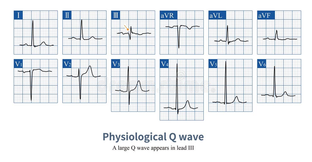 Physiological Q wave stock illustration. Illustration of sinoatrial ...