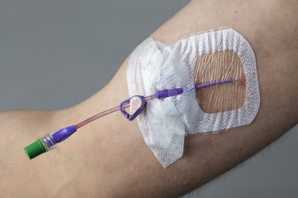 Picc Peripherally Inserted Central Catheter Stock Photo - Image of ...