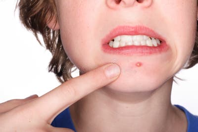Picking at a Pimple stock image. Image of embarassment - 1624639