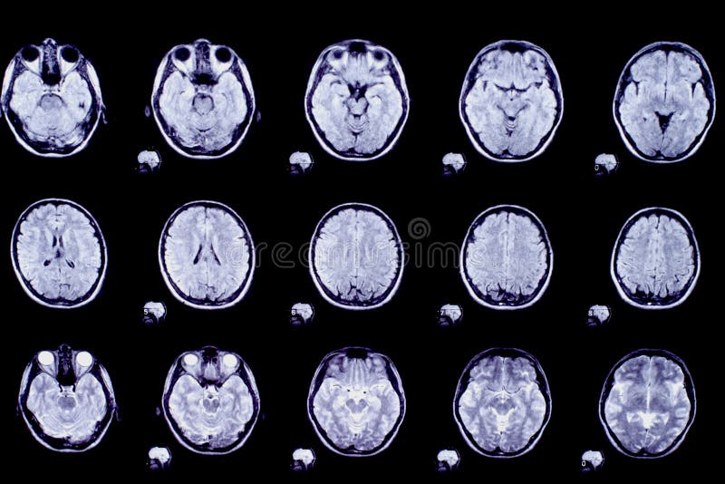 Picture of Computed Tomography the Brain. Black Stock Image - Image of ...
