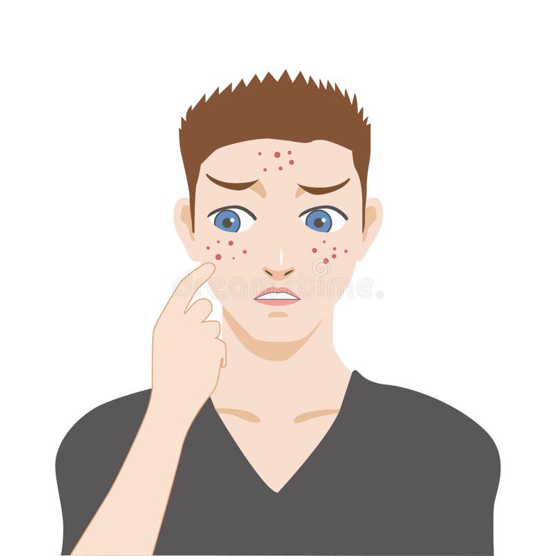Picture of a Guy with Acne on a White Background. Vector Illustration ...