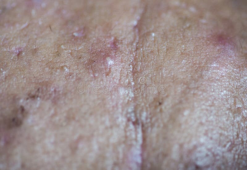 Picture of the Problem of Bumps and Red Rashes on the Skin on the Human ...
