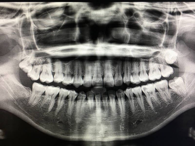 Picture of 32 Teeth Tooth Bone Dental Care Teeth Care Stock Photo ...