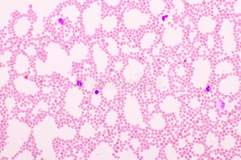 Picture of White Blood Cell, Red Blood Cell and Platelet in Blood Film ...