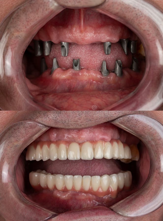 Before and after Pictures of Dental Implants and Press Ceramic Crowns ...