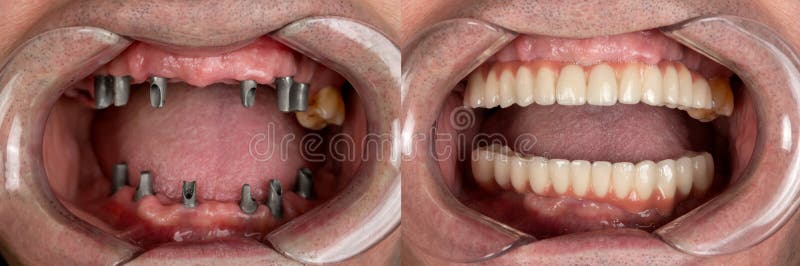 Before and after Pictures of Dental Implants and Press Ceramic Crowns ...