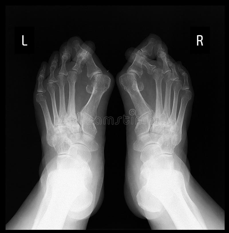 Radiografia Del Piede. Alluce Valgo Immagine Stock - Immagine di ...
