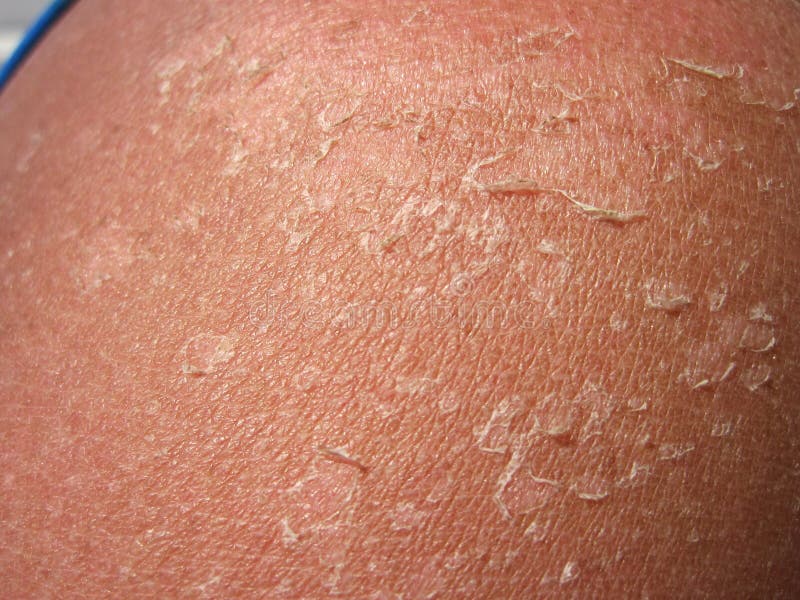 Bronceado En Piel Alrededor De La Rodilla De La Pierna Izquierda Del ...