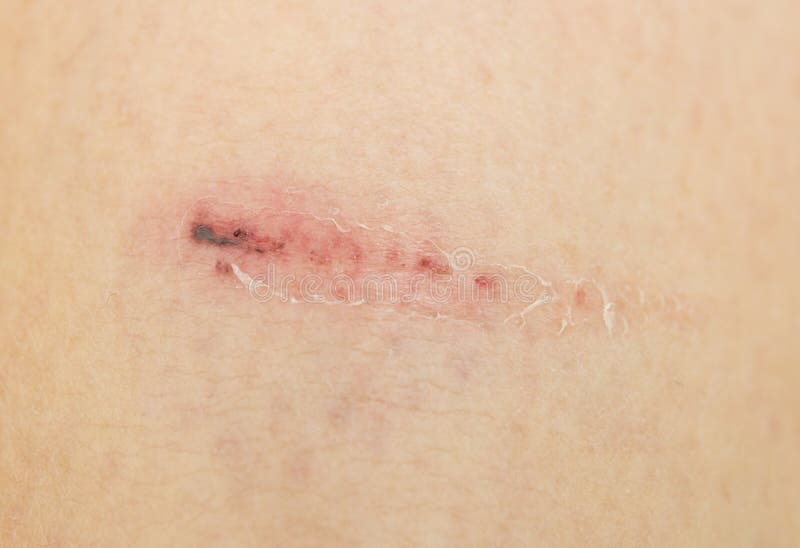 Piel raspada foto de archivo. Imagen de salud, rojo - 102290422