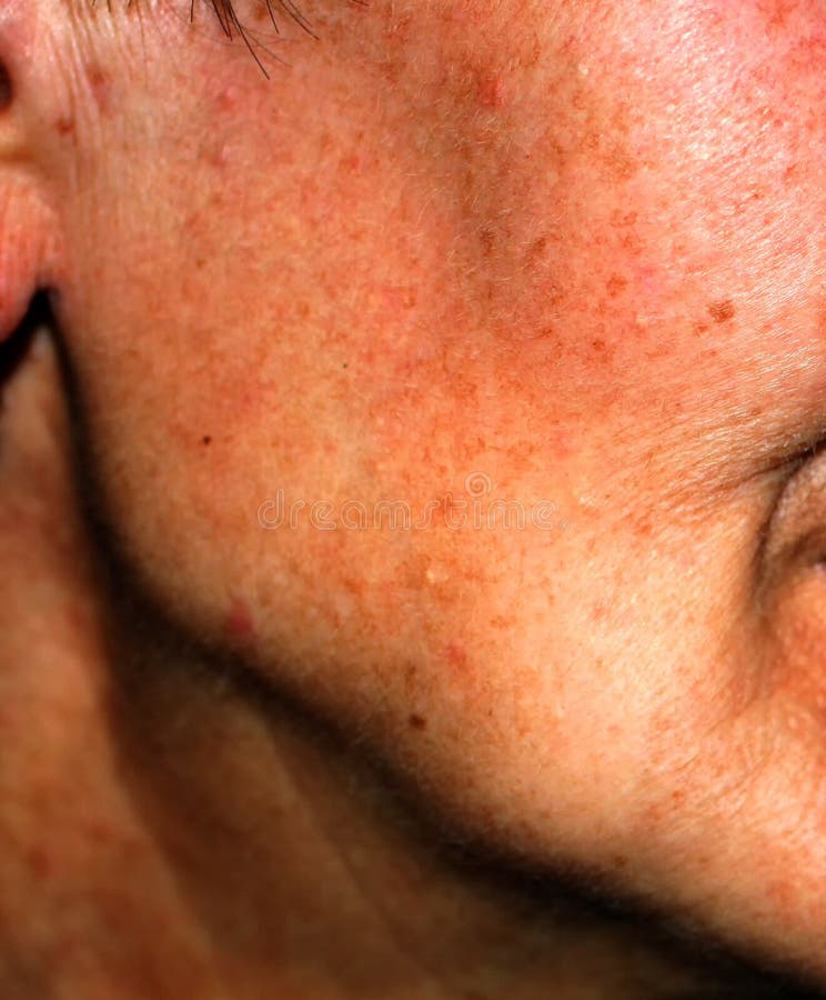 Pigmentation on Cheek. Brown Spots on the Skin. Stock Image - Image of ...