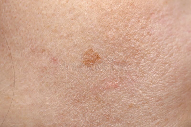 391 Tache Rouge Sur La Peau Photos libres de droits et gratuites de ...