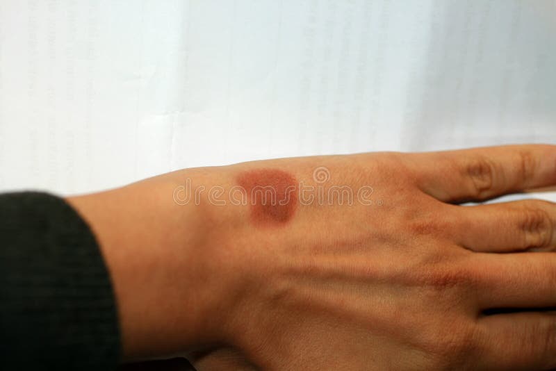 Pigmentation Tache Brune Sur La Main Tache De Colorant Sur La Peau ...