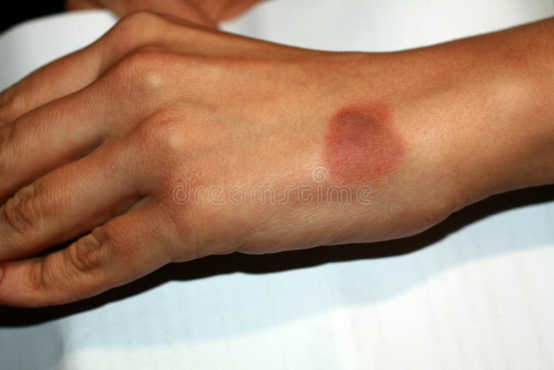 La Grande Tache Rouge Sur Le Plan Rapproché De Peau Photo stock - Image ...