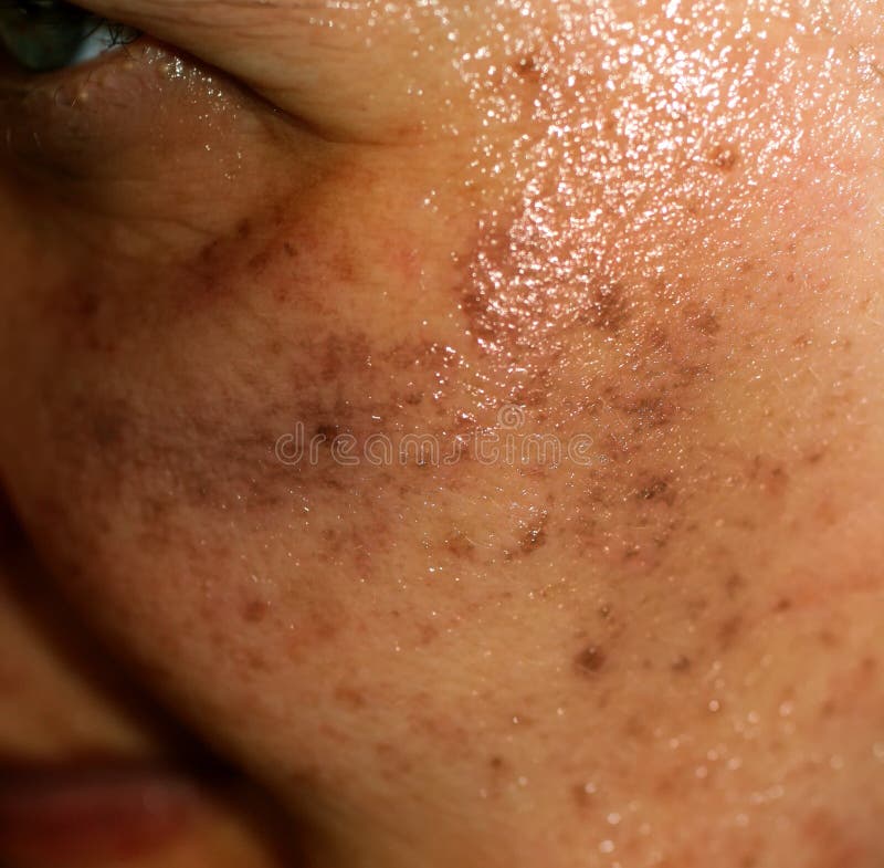 Pigmented Spots on the Face. Pigmentation on Cheeks Stock Image - Image ...