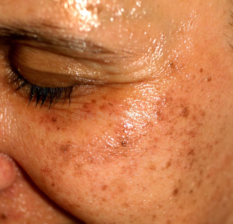 Pigmented Spots on the Face. Pigmentation on Cheeks Stock Photo - Image ...