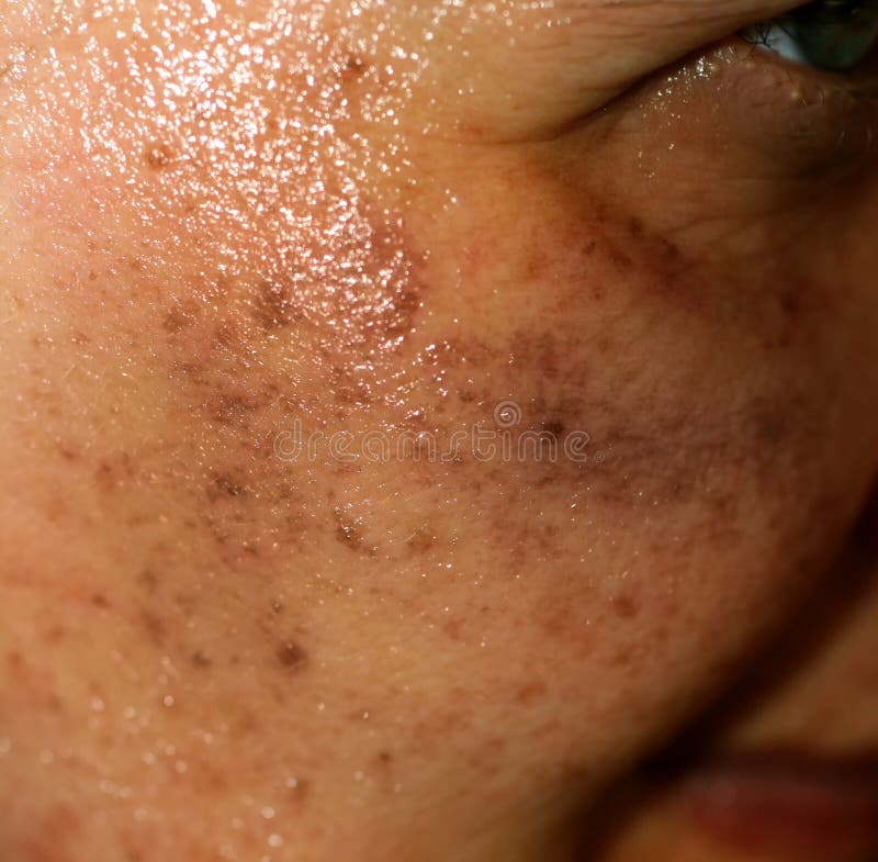 Pigmented Spots on the Face. Pigmentation on Cheeks Stock Photo - Image ...