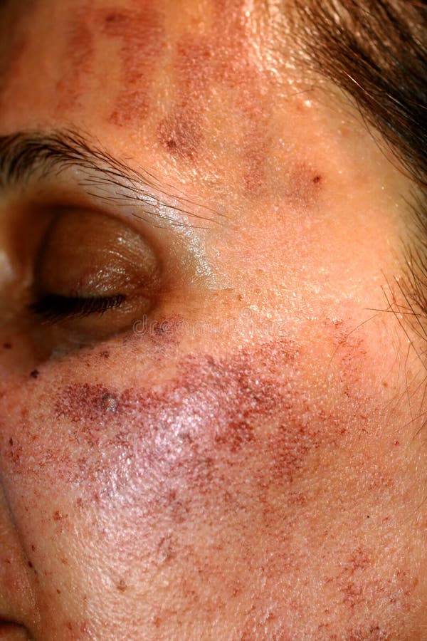 Pigmented Spots on the Face. Pigmentation on Cheeks Stock Photo - Image ...
