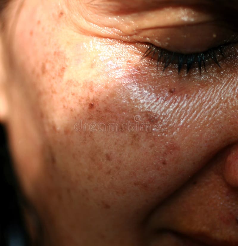 Pigmented Spots on the Face. Pigmentation on Cheeks Stock Image - Image ...
