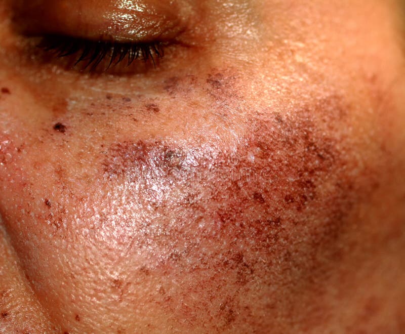 Pigmented Spots on the Face. Pigmentation on Cheeks Stock Image - Image ...