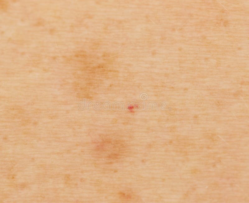 Pigmented Spots on the Skin Close-up Stock Image - Image of people ...
