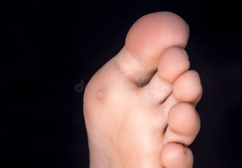 Graan of Clavus Op Vrouwelijke Voet Het Toepassen Van Zalf Op De Blaren ...