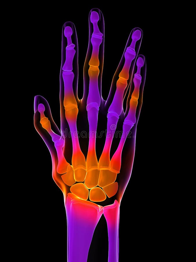Pijnlijke Pijn in De Handpalm of Pols Stock Illustratie - Illustration ...