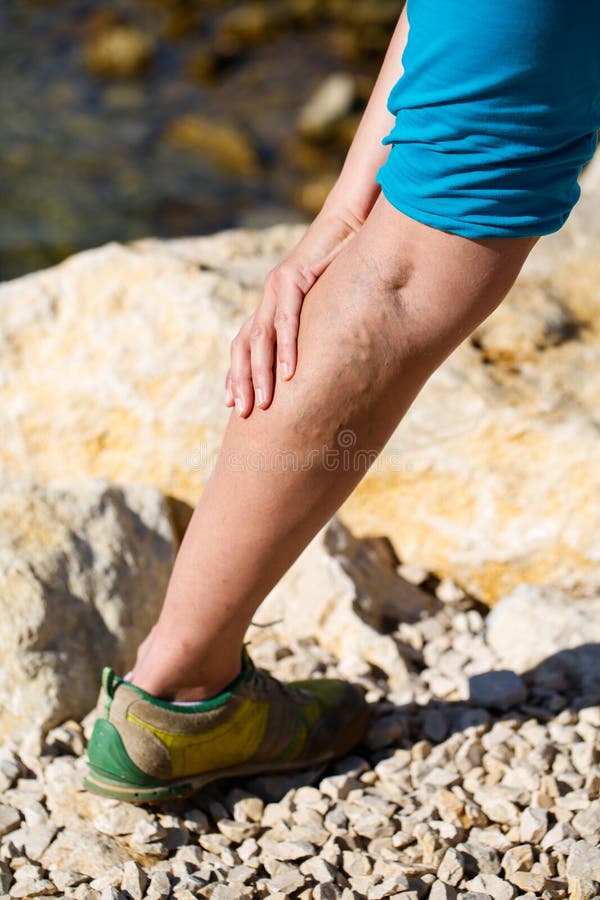 Vrouw Wat Betreft Pijnlijke Spataders Op Een Been Met Rood Punteffect ...