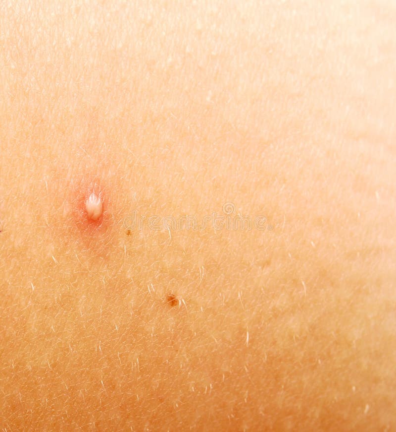 On the Body is a Large Purulent Pimple with Redness. Acne Disease Stock ...