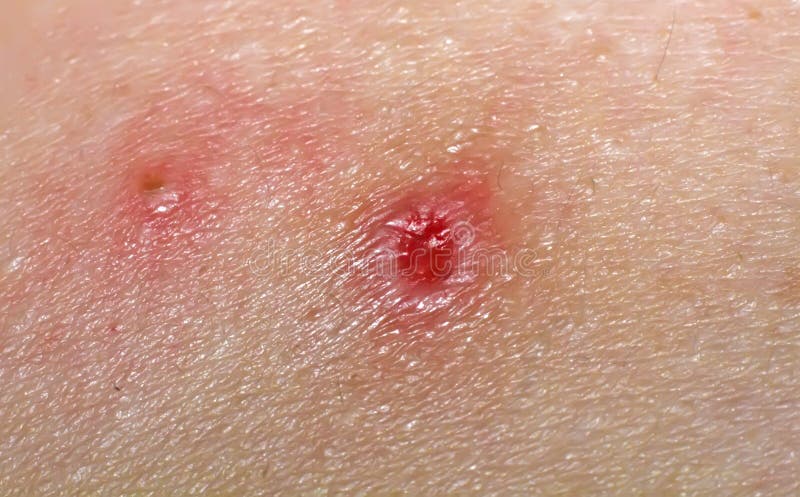 Pimple Extreme Macro stock image. Image of dermatitis - 14887981